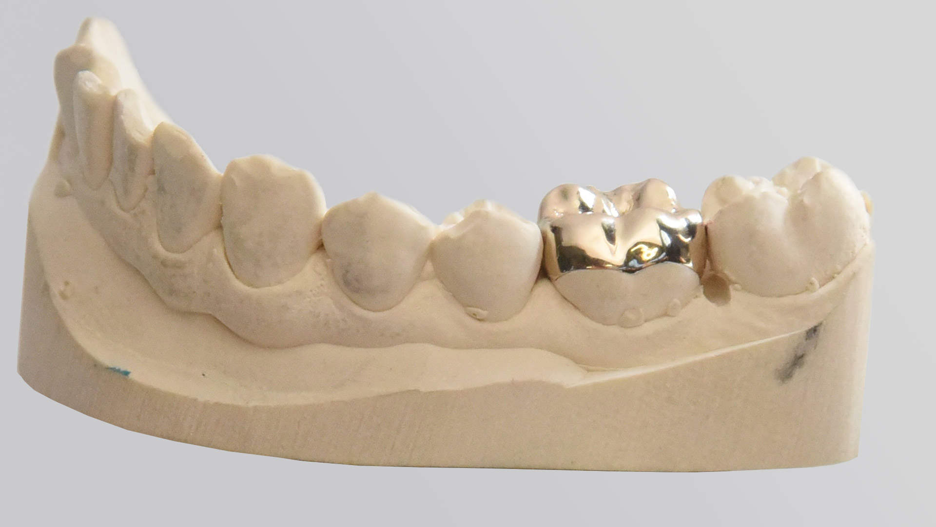 Milled gold dental restorations | Strategy Milling